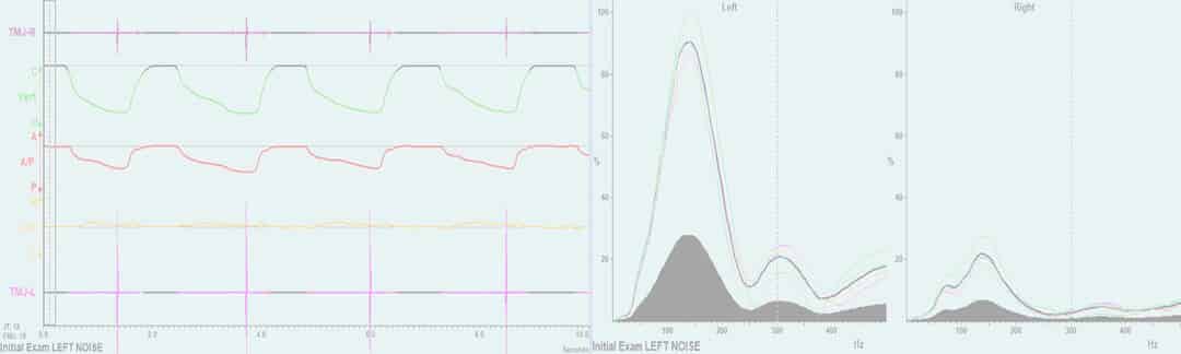 Sensitivities and Specificity of Joint Vibration Analysis (JVA): A ...