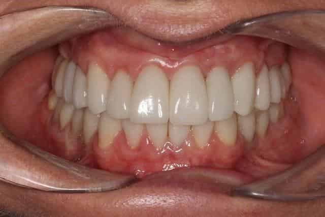 The perils of “phantom bite syndrome” or “occlusal dysaesthesia ...