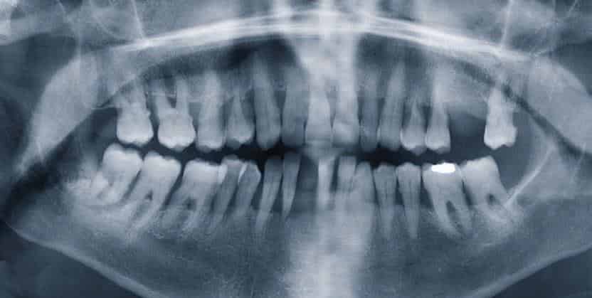 Application of the new periodontal classification: generalised ...