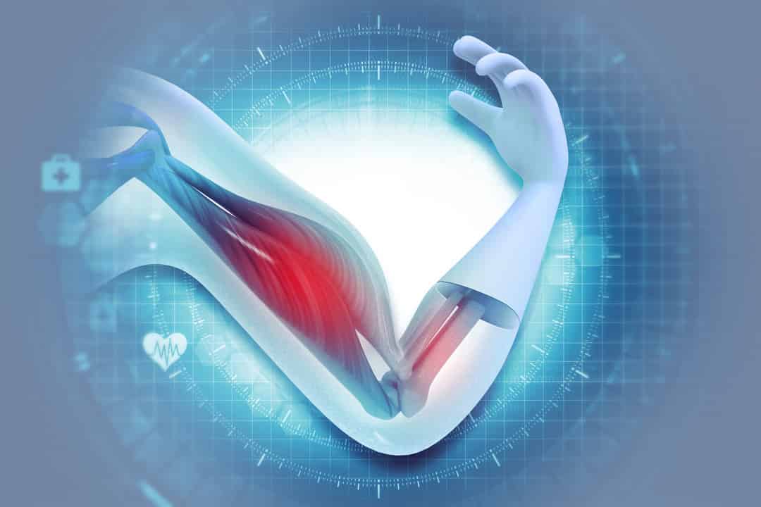 New reconstructive option in chronic distal biceps ruptures. A case ...