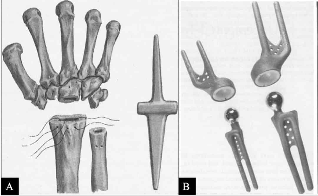 The Evolution & Outcomes of Total Wrist Arthroplasty: Current Concepts ...