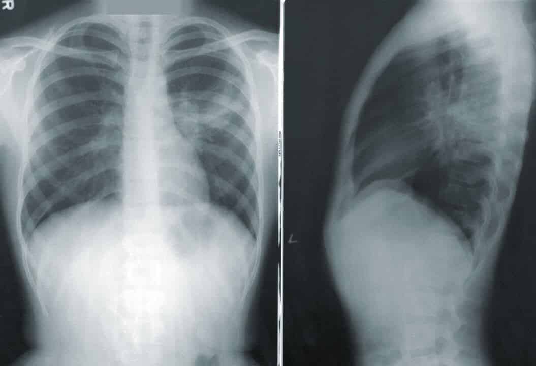 Ectopic Cushing’s Syndrome as the First Presenting Sign of Small Cell ...