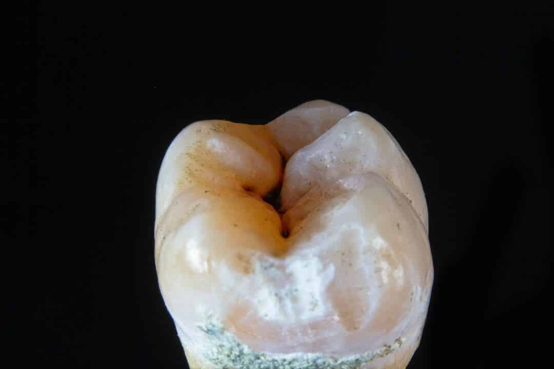 Visual Examination For Caries Detection Published In Journal Of The