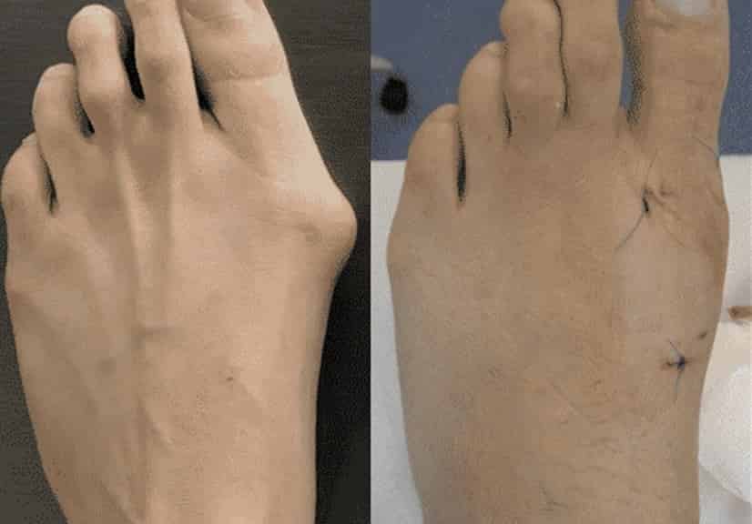 Minimally Invasive Bunion Surgery for Hallux Valgus: A surgical ...