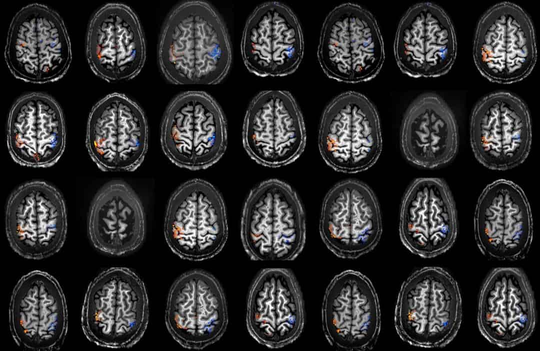 Evaluating the capabilities and challenges of layer-fMRI VASO at 3T ...
