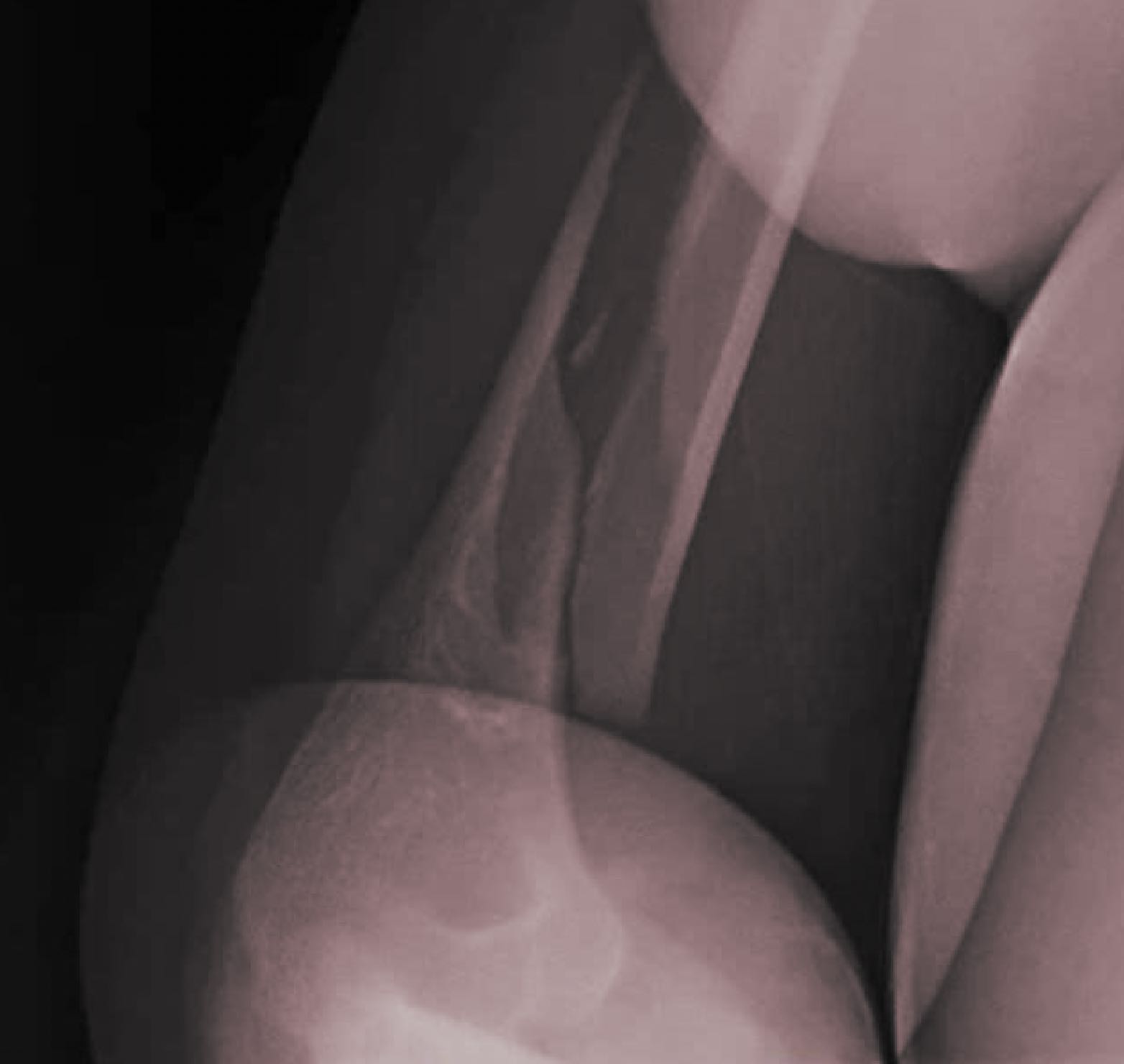 left humerus fracture cpt code