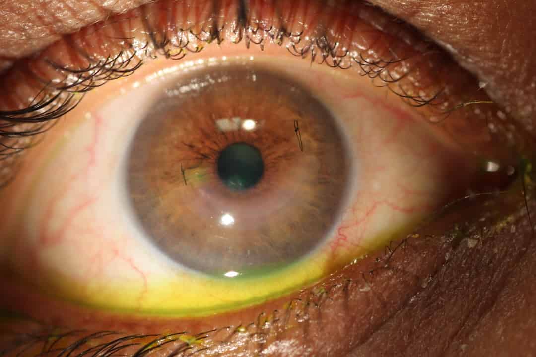 Case Report of Corneal Allogenic Intrastromal Ring Segment (CAIRS) in a ...