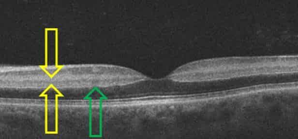 Case Report: Retinal Artery Occlusion Associated with Patent Foramen ...