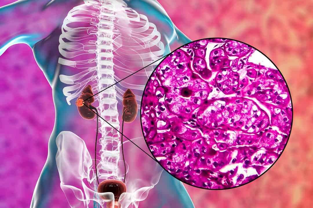 Reninoma: A Case of a Small Renal Mass Removed with Robotic-Assisted ...