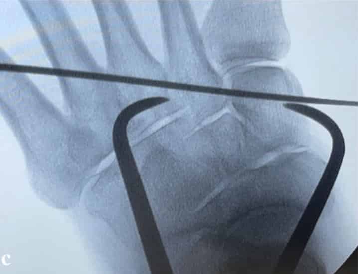 Outcomes of Lisfranc Injuries Treated with a New Flexible Fixation ...