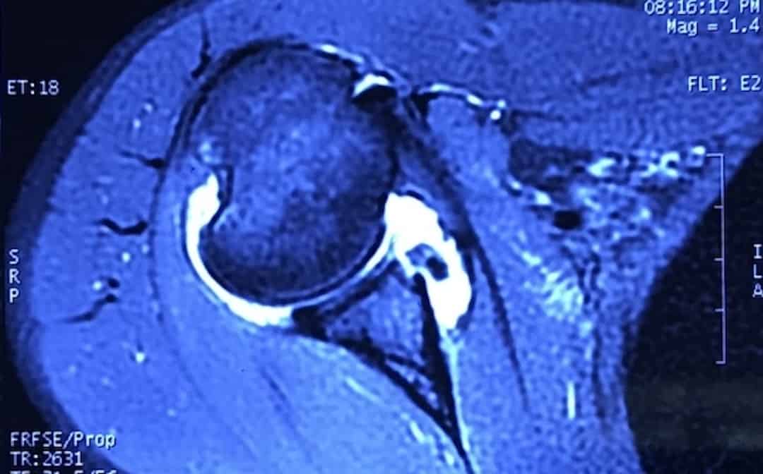 Arthroscopic Bankart versus Open Latarjet; Short-to-Mid-Term Outcomes ...
