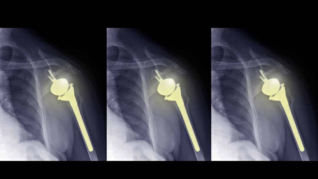 The 50 most-cited publications in reverse total shoulder arthroplasty ...