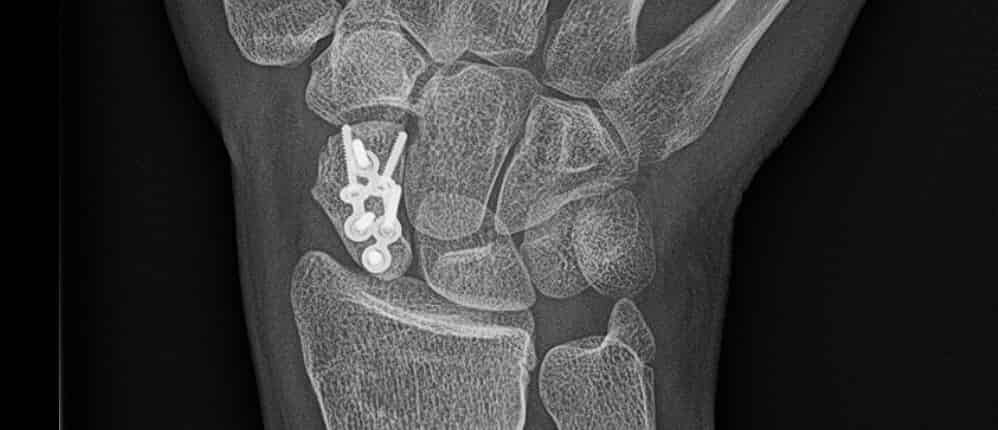 Volar Locking Plate Fixation for Scaphoid Fractures: Surgical Technique ...