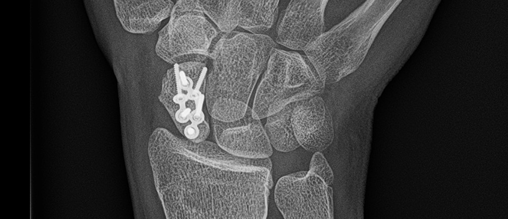 scaphoid angle view