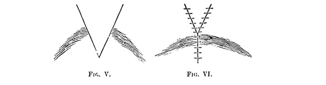 The first English textbook of plastic surgery—William (Jerry) Moore ...