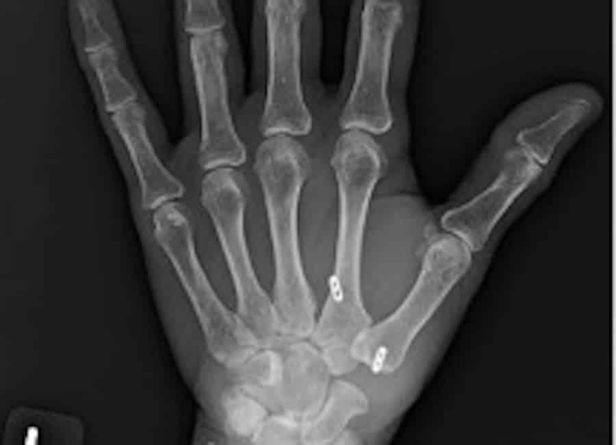 First Carpometacarpal Joint Arthritis: A Review of Surgical Management ...