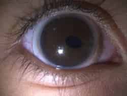 Management of Pediatric Open Globe Injury With Fenestrated Scleral Lens ...