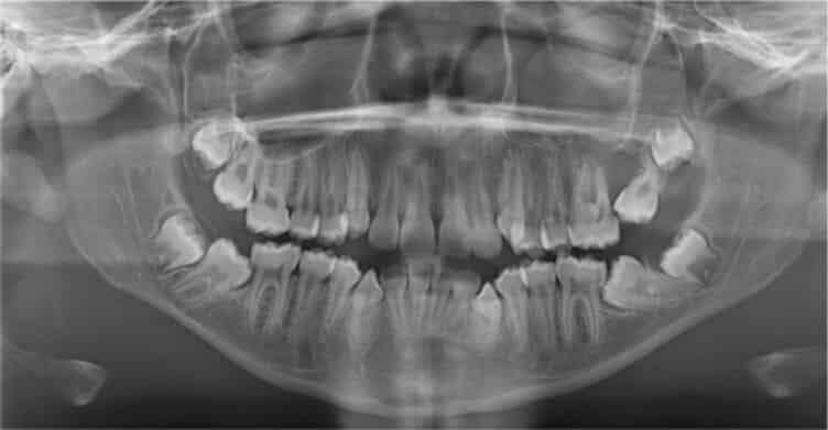 An inflammatory Odontogenic Cyst (Unusual Case): A case report ...