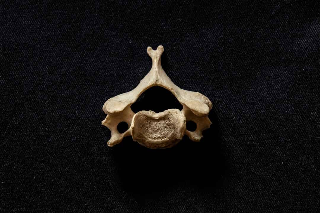 MANAGING LUMBAR SPINAL STENOSIS WITH LOGAN TECHNIQUE: A CASE REPORT ...