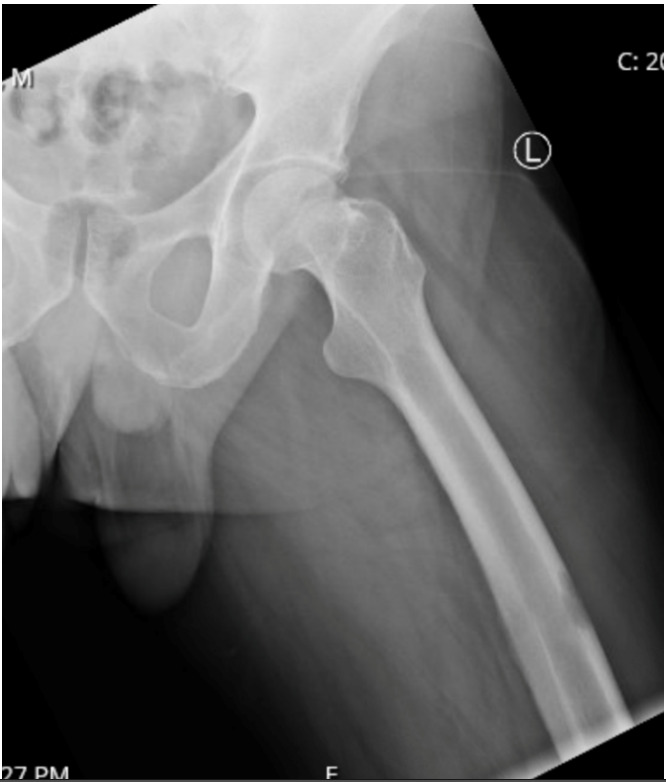 Skeletal Metastases of the Pelvis and Lower Extremity: A Review for the ...