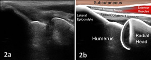 Diagnostic Musculoskeletal Ultrasound for the Evaluation of the Lateral ...