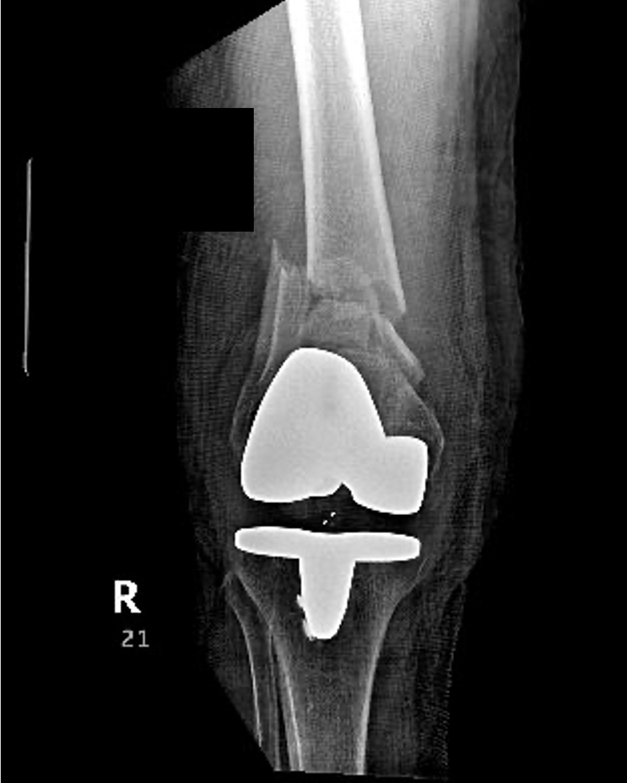 Early Weight Bearing after Distal Femur Fractures in the Elderly: A ...