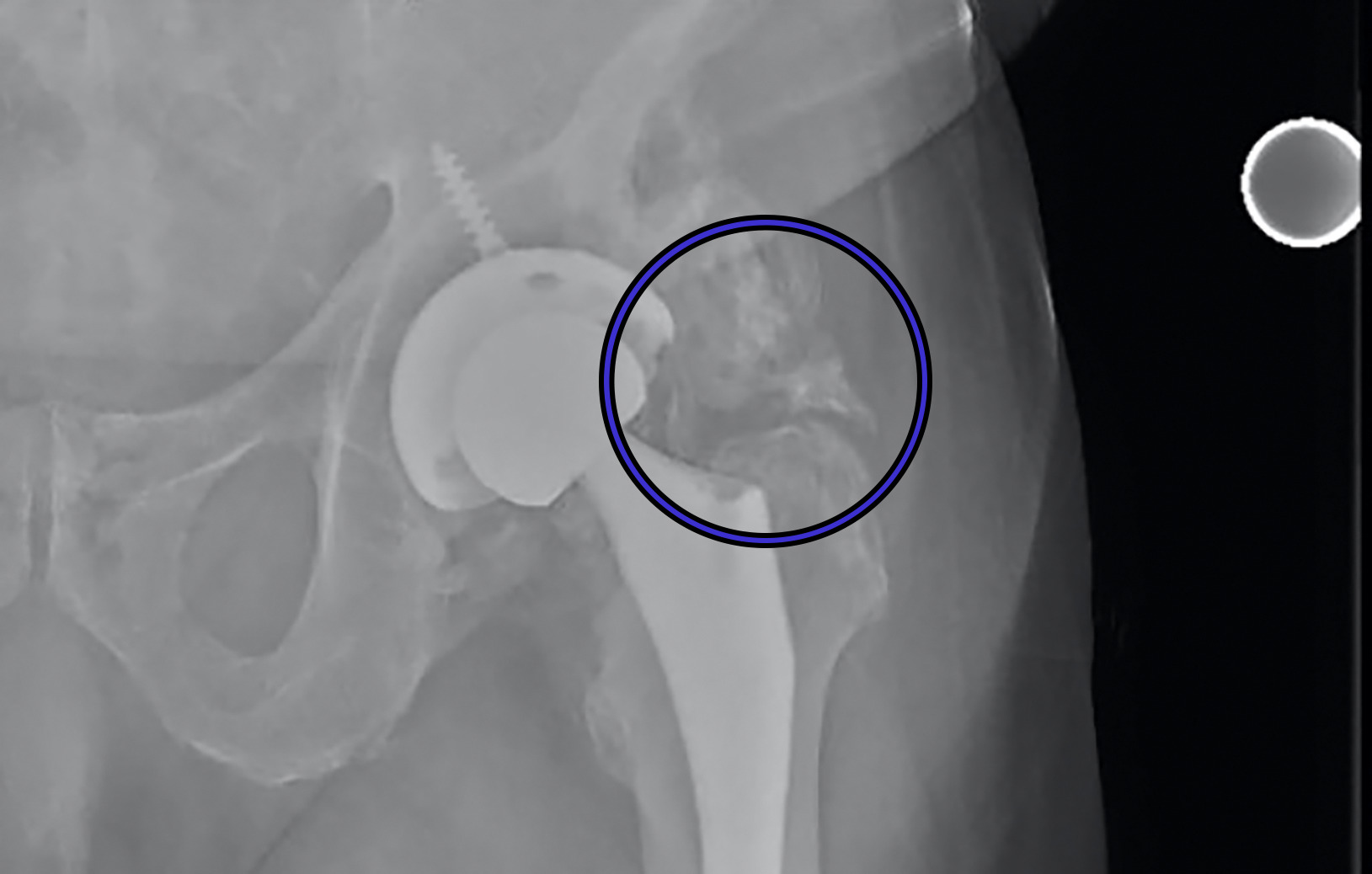 Incidence of Heterotopic Ossification in Direct Anterior Approach to ...