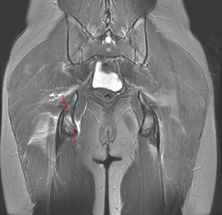 Ischial Tuberosity Fracture