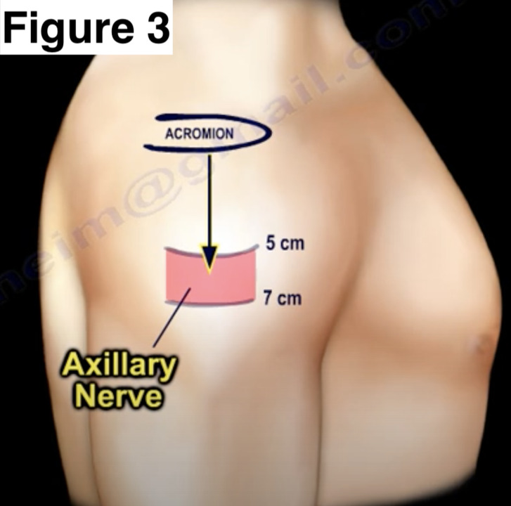 axillary nerve problems
