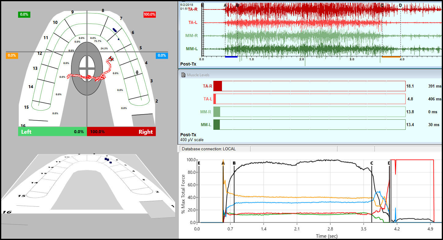 Digital evaluation of Occlusion in Treating a Patient Suffering from ...