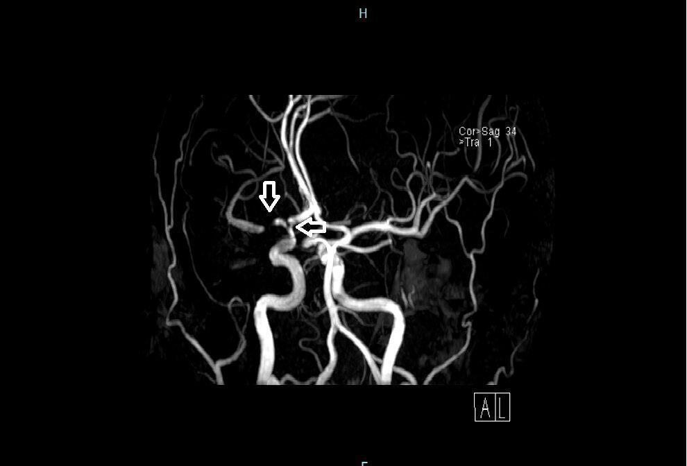 Unexplained Stroke and Multifocal Intracranial Stenosis due to ...