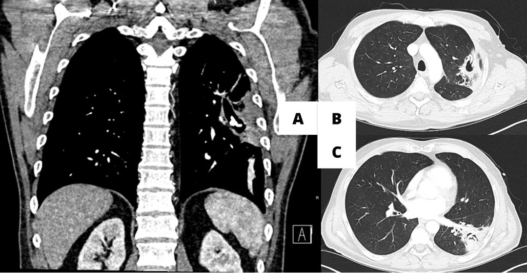 lung abscess ct
