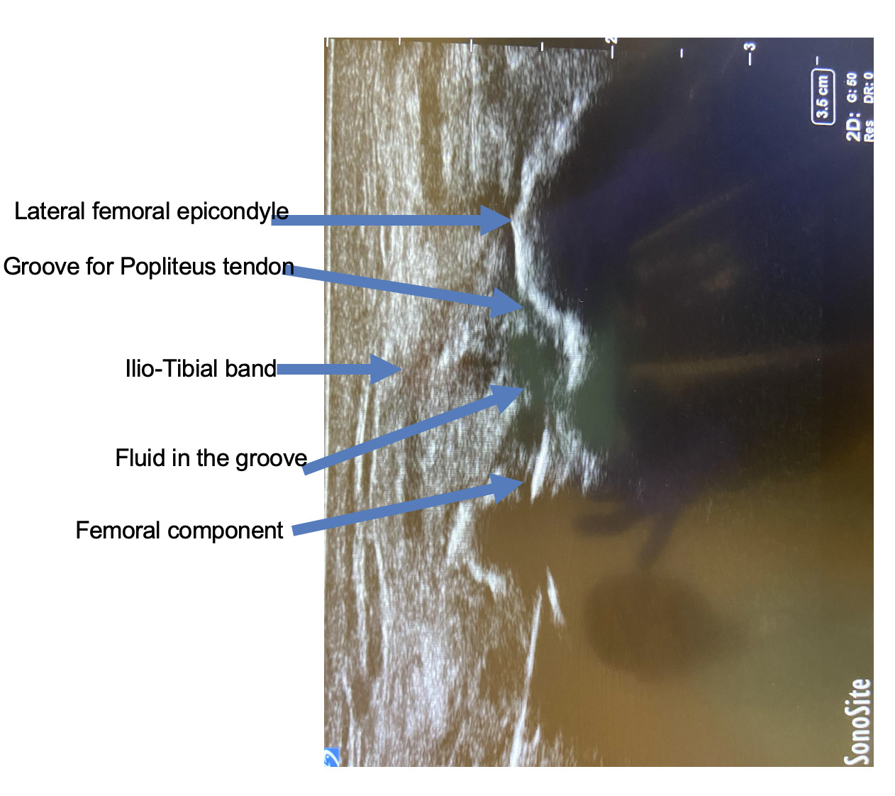 Isolated lateral-sided knee pain in total knee arthroplasty. A review ...