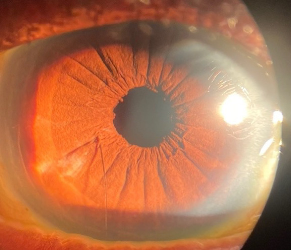 Case Report: Retained anterior chamber iatrogenic intraocular foreign ...