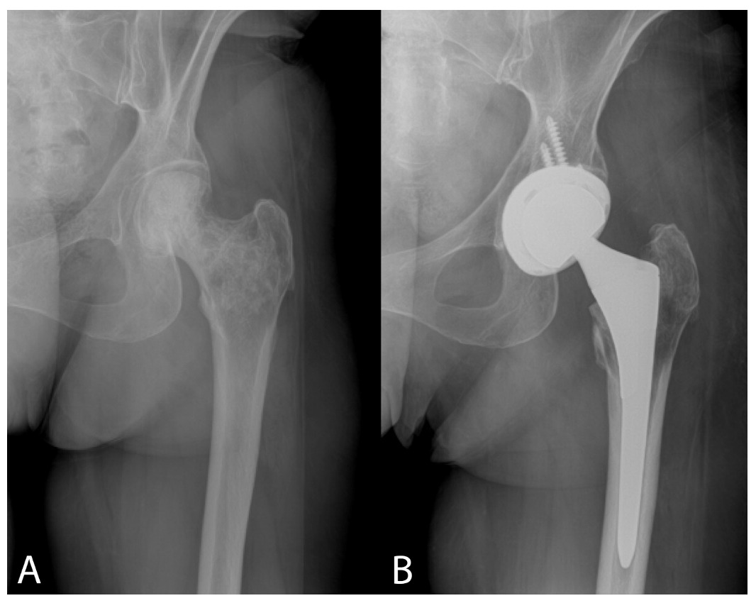 Hip Arthroplasty Outcomes in Patients with Metastatic Bone Disease ...