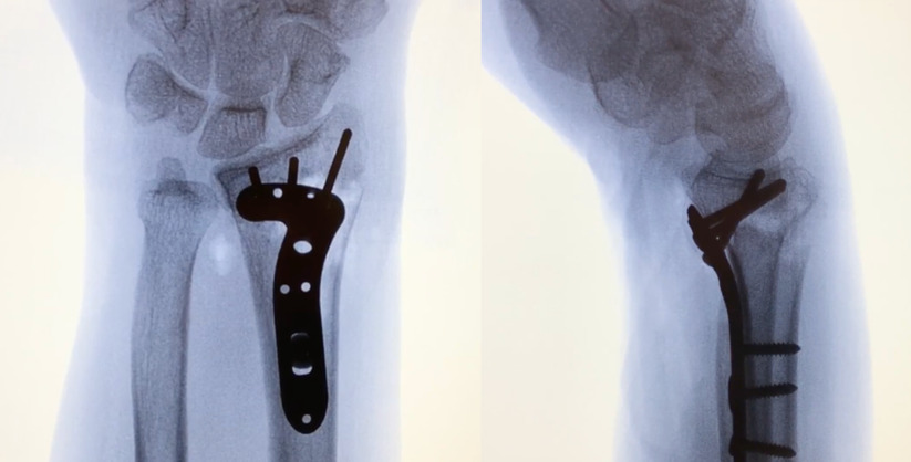 Volar Locking Plate Fixation of Distal Radius Fractures: A Surgical ...