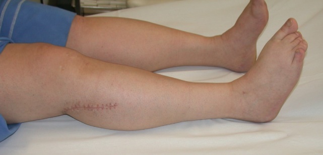 Nerve lesions during arthroscopic procedure: a literature overview ...