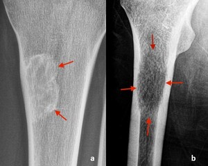 Top 10 Facts to Know about Bone Lesions Identified on Radiographs ...