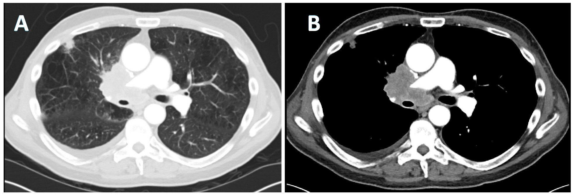Ectopic Cushing’s Syndrome as the First Presenting Sign of Small Cell ...