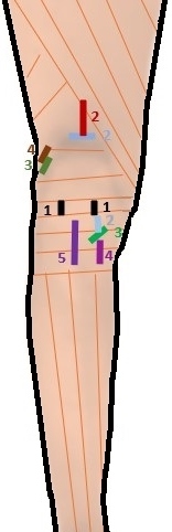 A Multi-Systems Approach to Human Movement after ACL Reconstruction ...