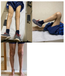 Total Knee Arthroplasty in Valgus Deformity Made Easy Using Robotic ...