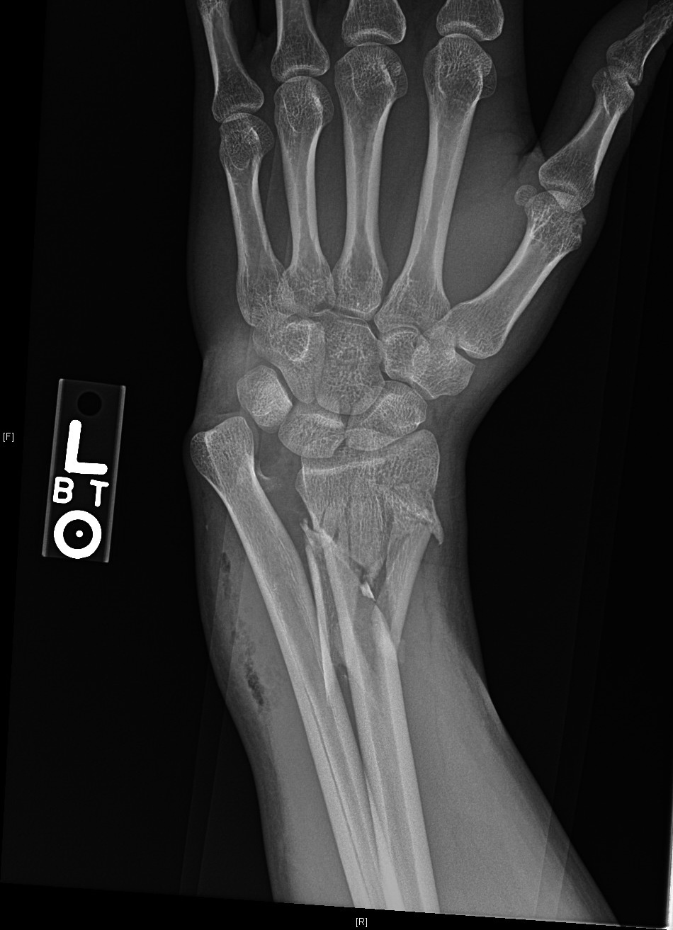 Distal Radius Fracture with Dislocation of the Radioulnar Joint ...