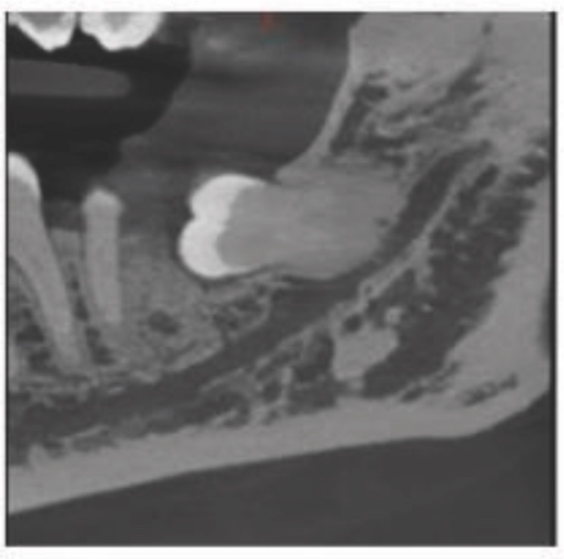 Coronectomy? A case report following coronectomy of a ‘high-risk ...