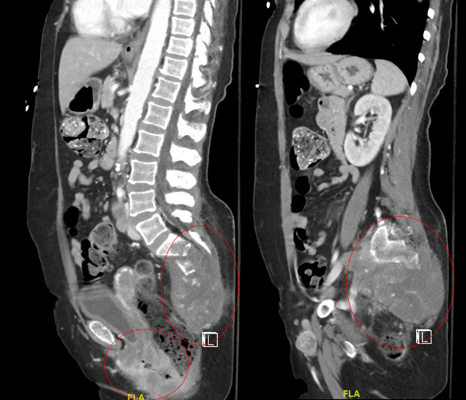 Distal Fibular Metastasis of Colorectal Carcinoma: A Case Report ...
