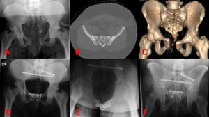 Midline Sacral Fractures: Review of the Literature | Published in ...