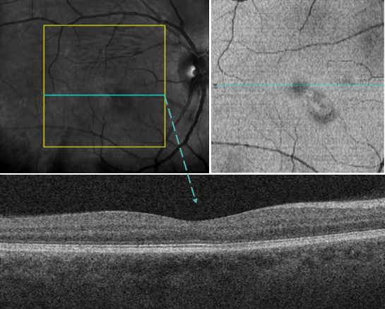Case Report: Acute Macular Neuroretinopathy Following Hepatitis A and ...