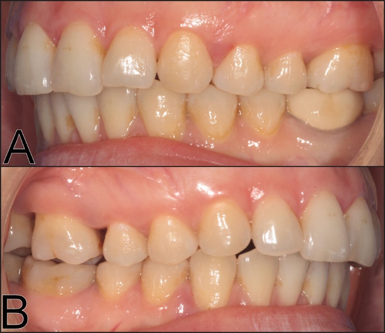 Characteristics Of Static And Excursive Occlusal Parameters In Subjects ...