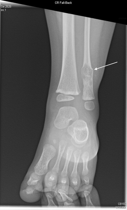 pathological fracture example