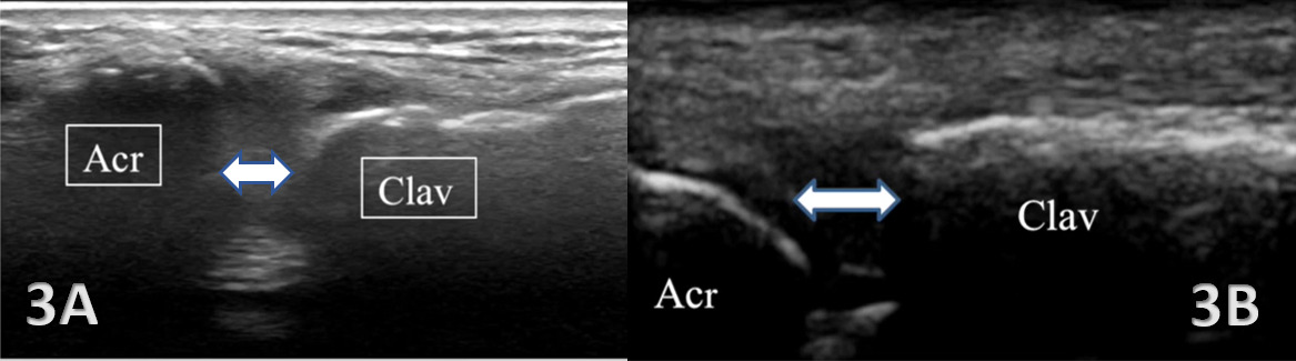 MSK Diagnostic Ultrasound for the Assessment of the Acromioclavicular ...