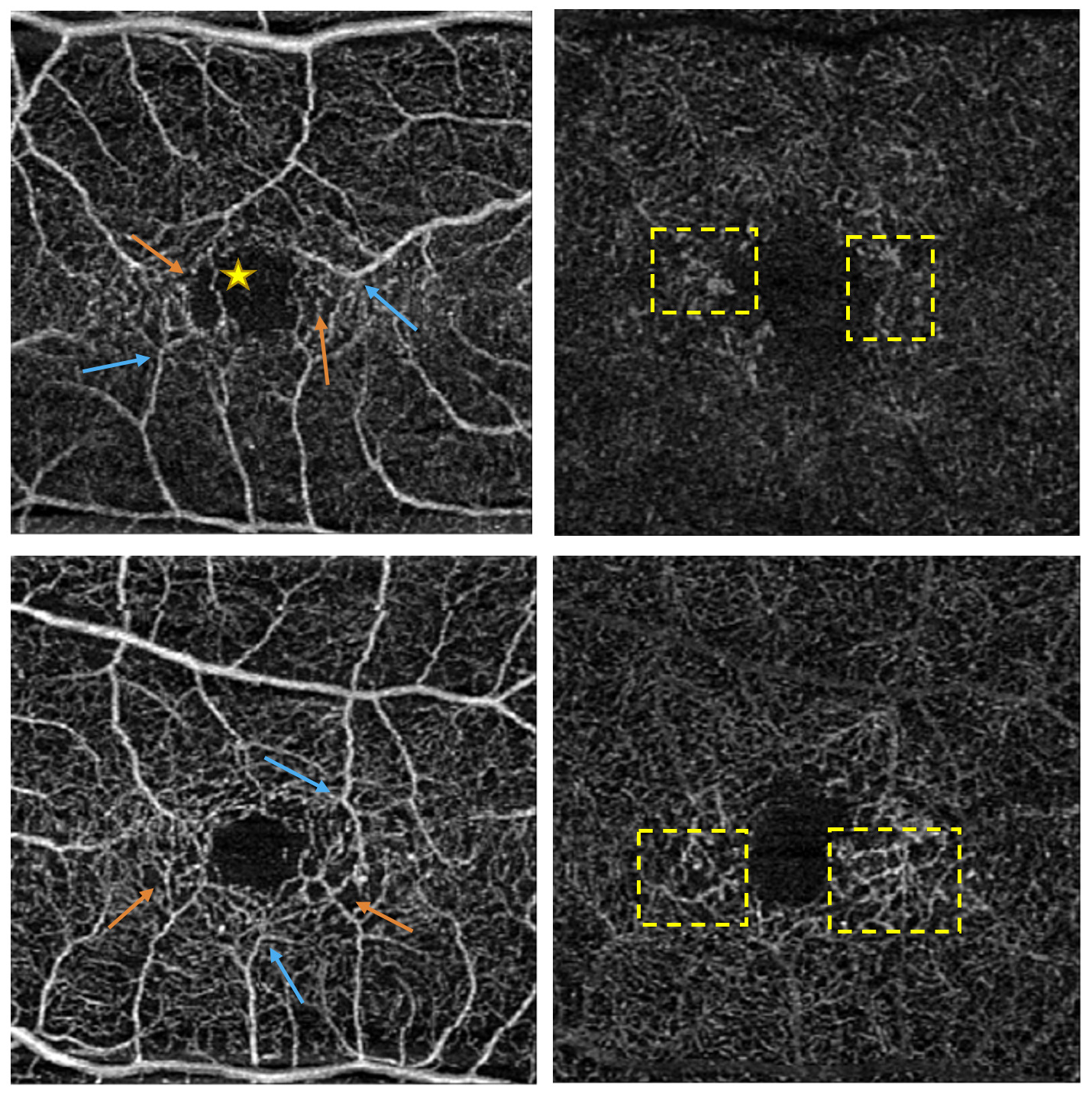Macular Telangiectasia Type 2: Case Report and Clinical Review ...